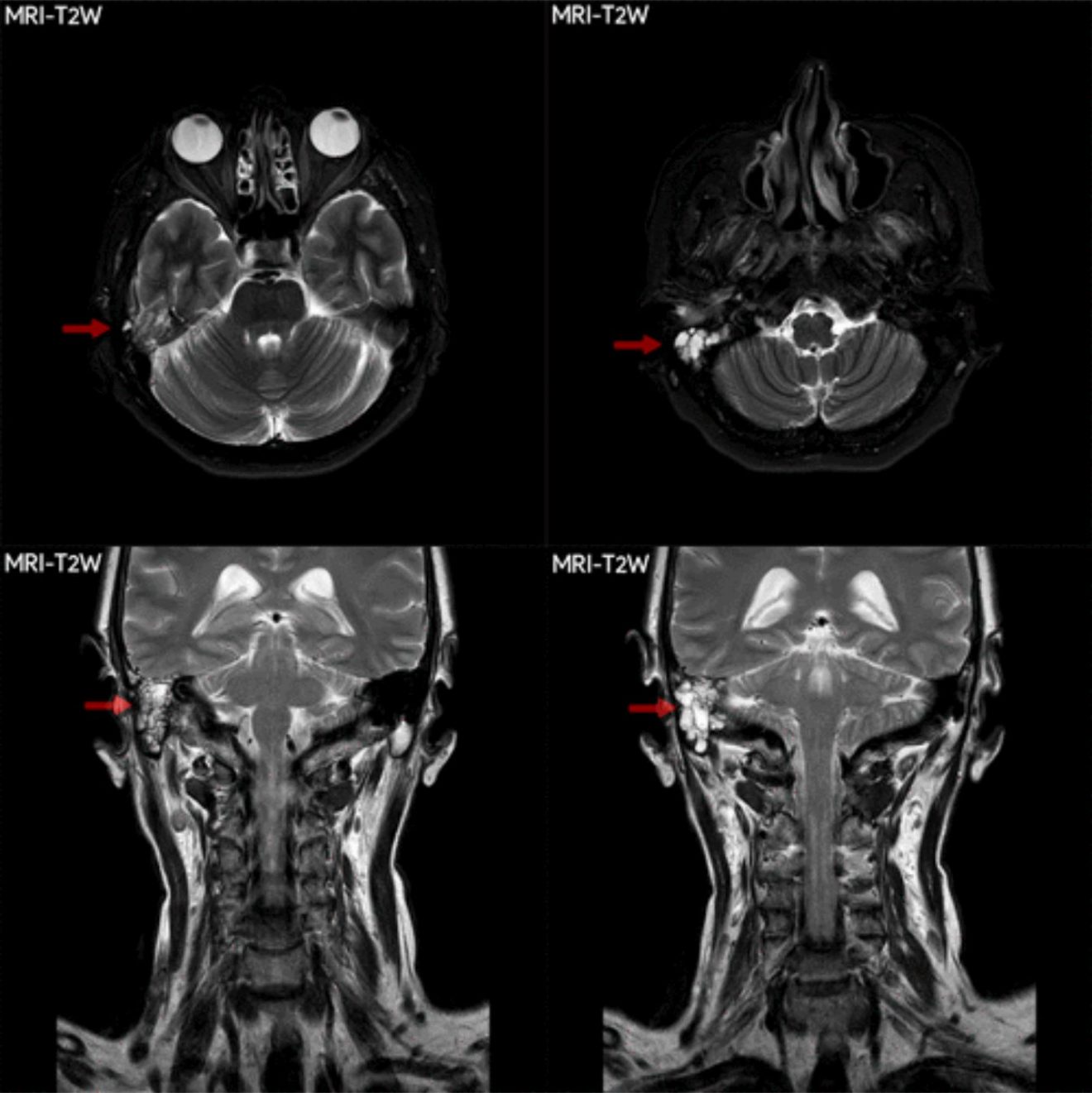 The Use of Giant Bilobed Flaps for Tissue Defect Reconstruction After ...